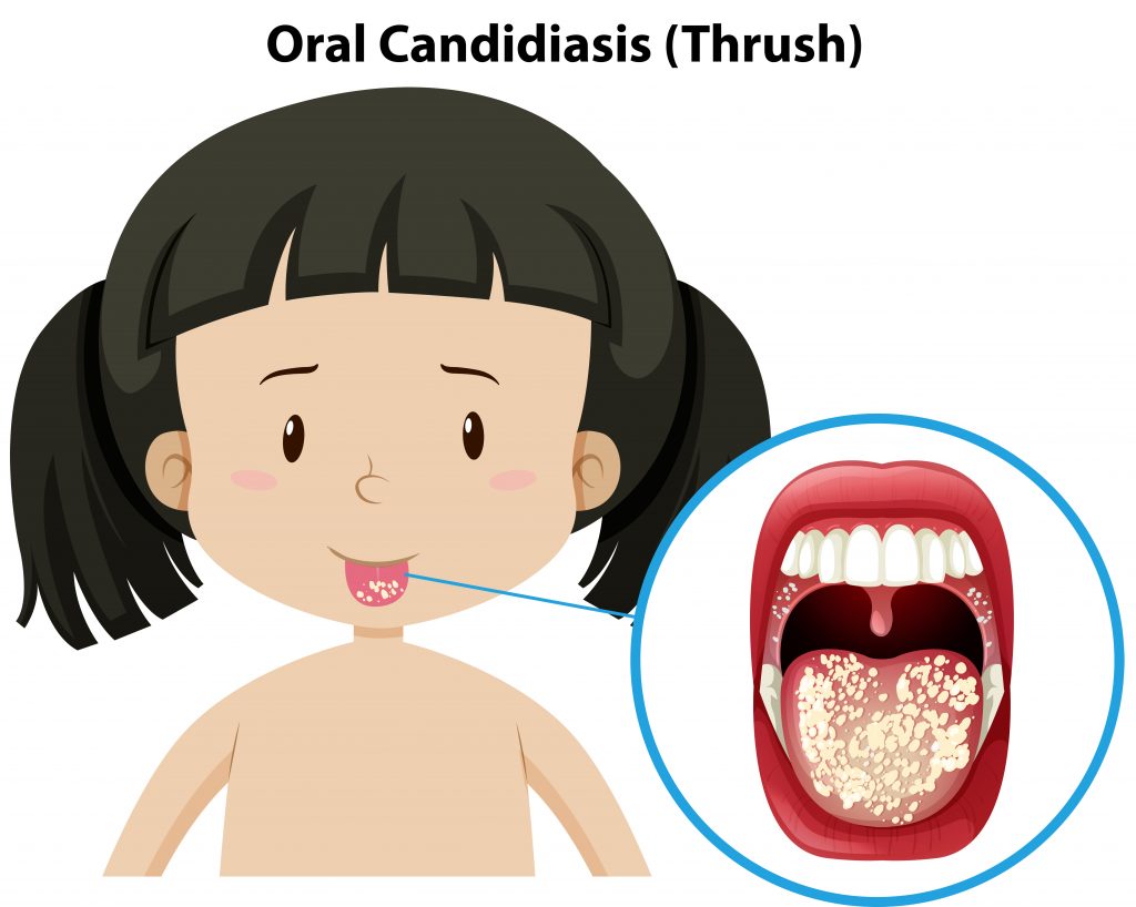 Candidoza bucala, simptome si tratament la nou-nascuti, sugari si ...
