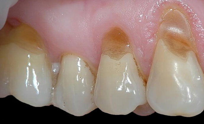 cauze si tratament leziuni dentare Archives - ABC Eurodent