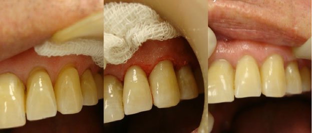 Defect cuneiform - leziuni cuneiforme - ABC Eurodent, clinica familiei