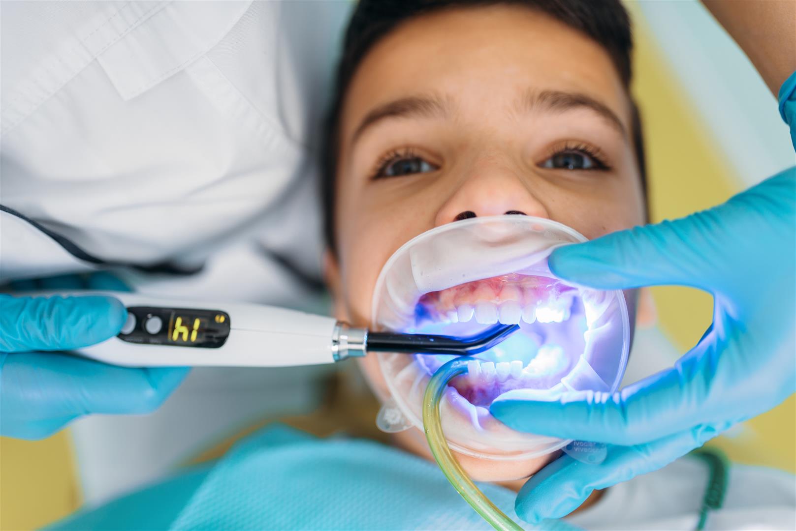 Sigilare dentara, o metoda perfecta pentru a tine cariile departe