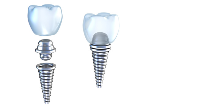 Protetica fixa - punte dentara - ABC Eurodent, clinica familiei tale