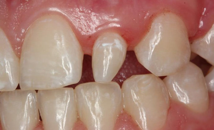 Anomalia dentara de forma - ABC Eurodent, clinica familiei tale
