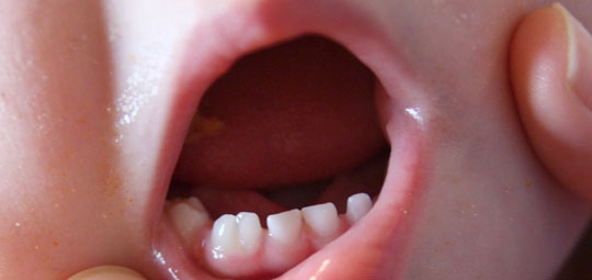 Anomalia dentara de forma - ABC Eurodent, clinica familiei tale