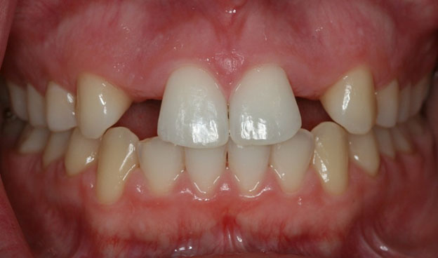 Dinti lipsa din nastere. Anodontia. - ABC Eurodent, clinica ta