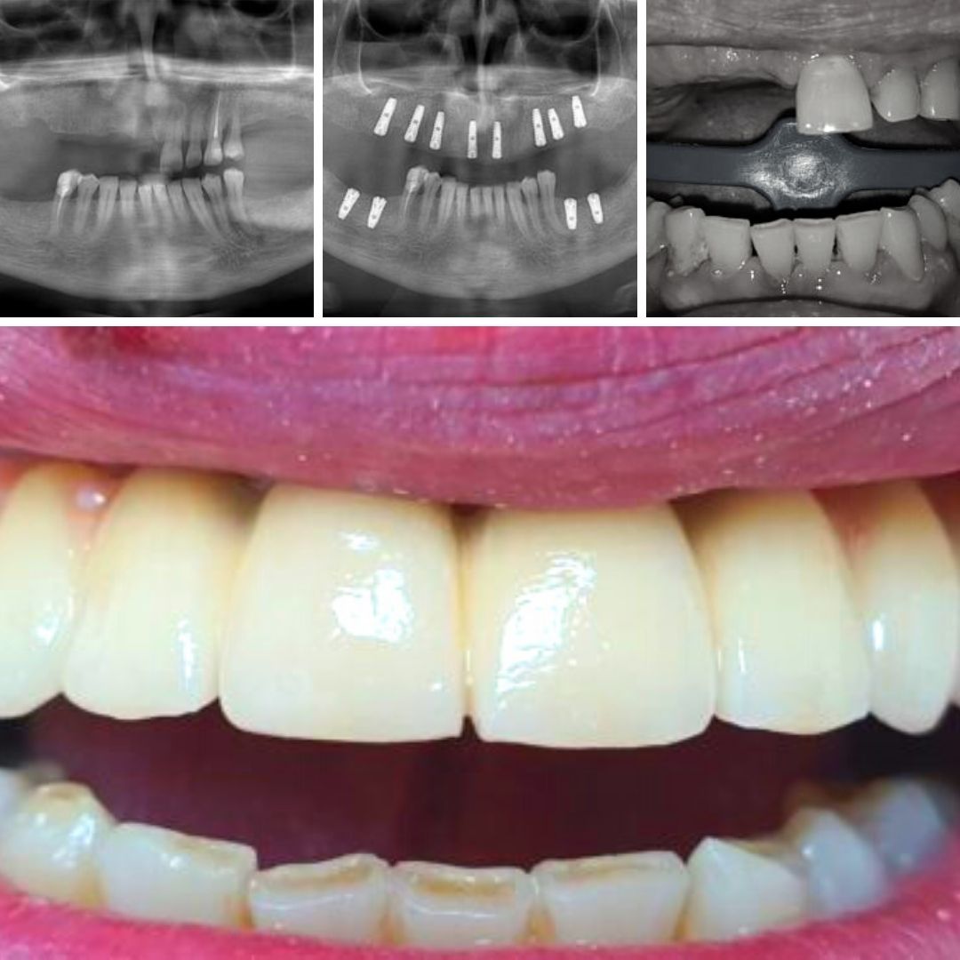 Pasi in inserarea unui implant dentar si rezultate - ABC Eurodent