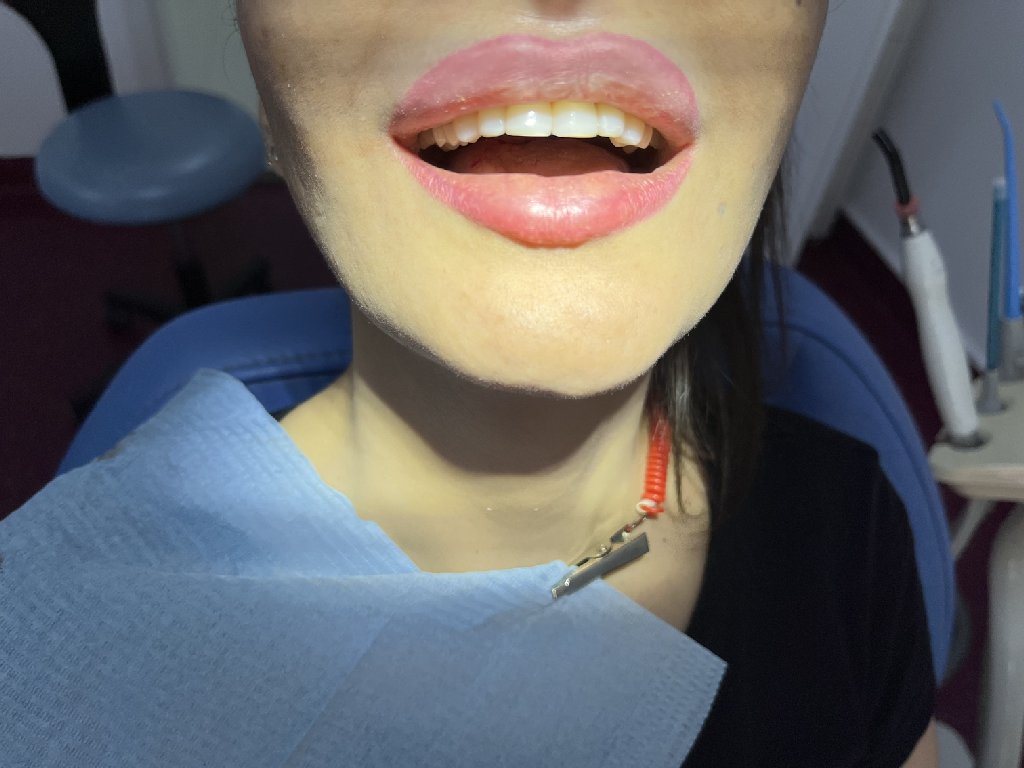 Fatete dentare din compozit: zambet perfect, in doar 4 ore